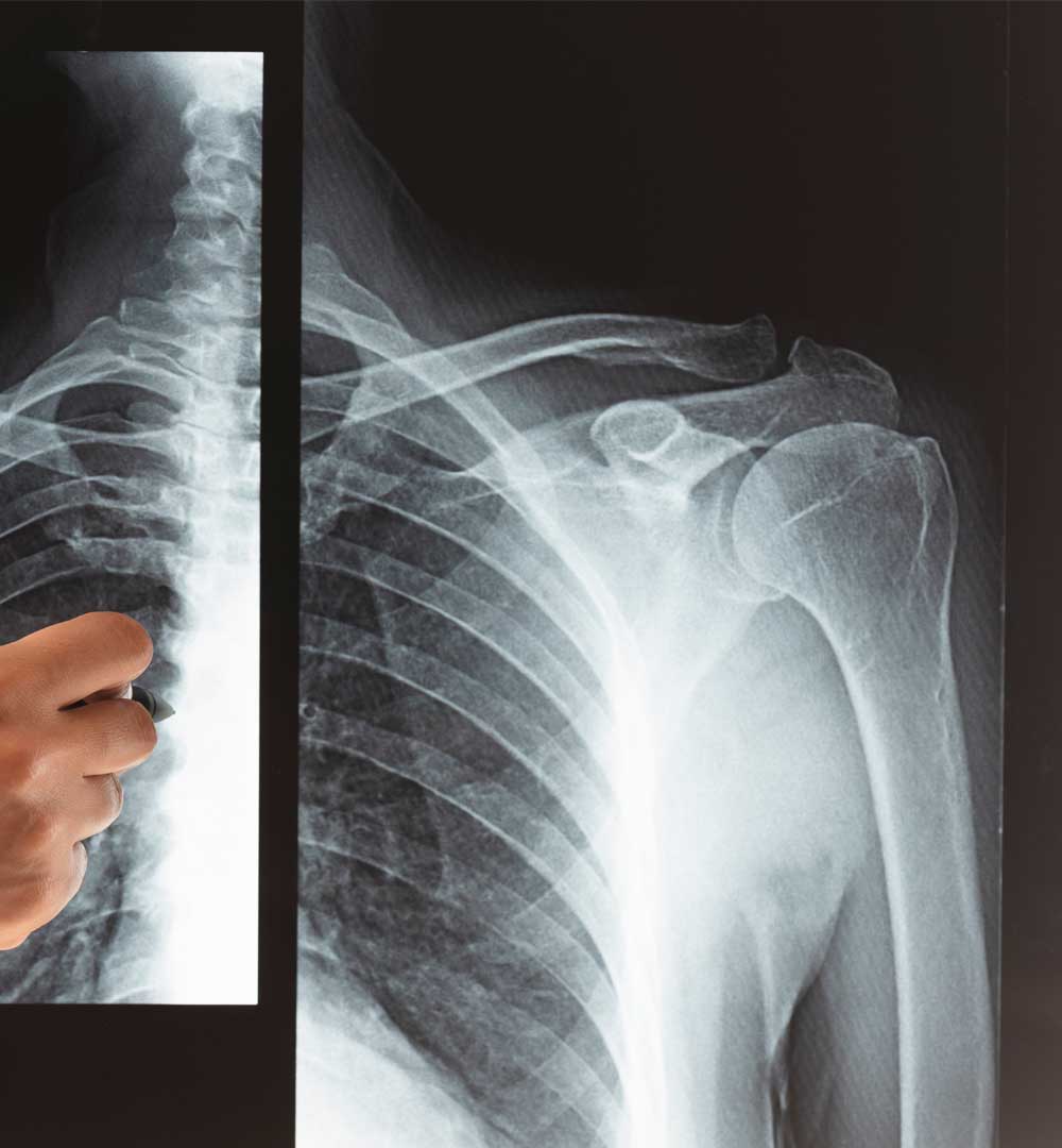 Radiografía de hombro izquierdo